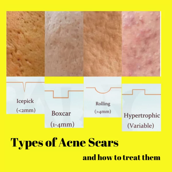 What causes Acne & Acne Scars and treatments - Dr Cindy's Medical ...